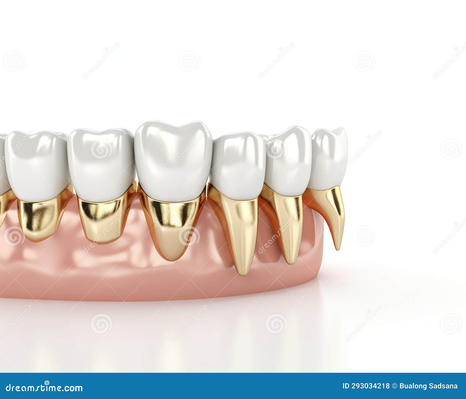 The Lower Jaw Has a Post and Core Tooth Restoration. Stock Illustration ...