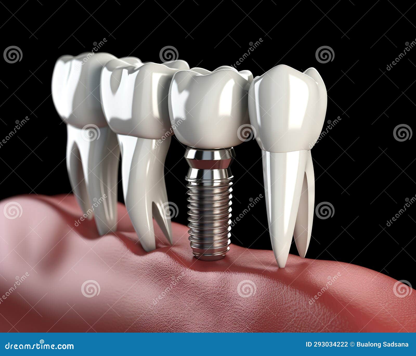 3d Render Of Lower Jaw With Broken Incisor Tooth Stock Photo ...