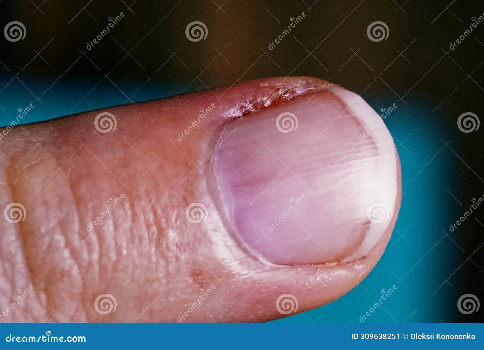 The Image Shows a Finger with a Visible, Healing Wound Stock Image ...