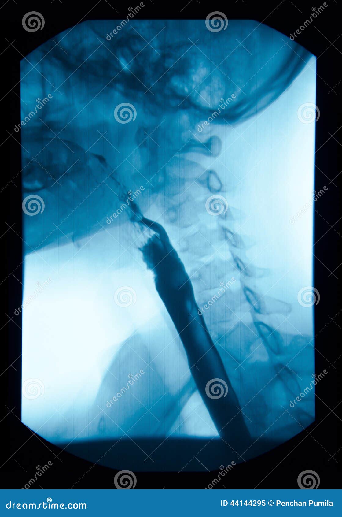 Esophagram Or Barium Swallow AP And Lateral View Showing Esophagus For ...