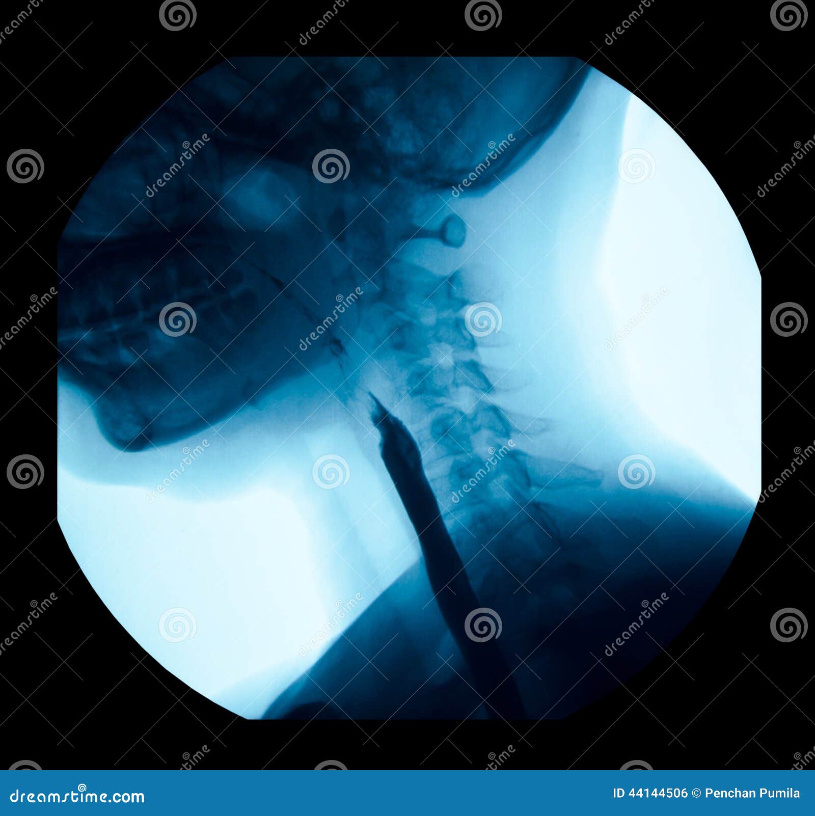 Esophagram Or Barium Swallow AP And Lateral View Showing Esophagus For ...