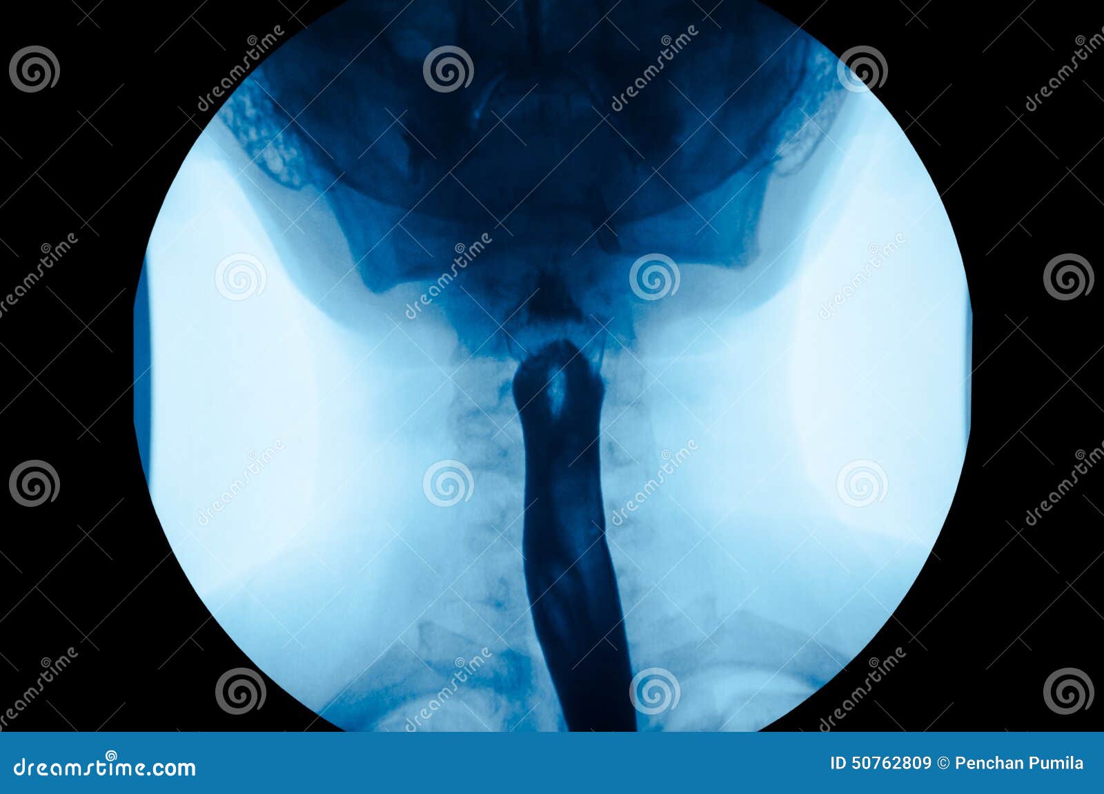 X-ray Of The Upper Gastrointestinal Tract UGI With Barium. Hiatal ...