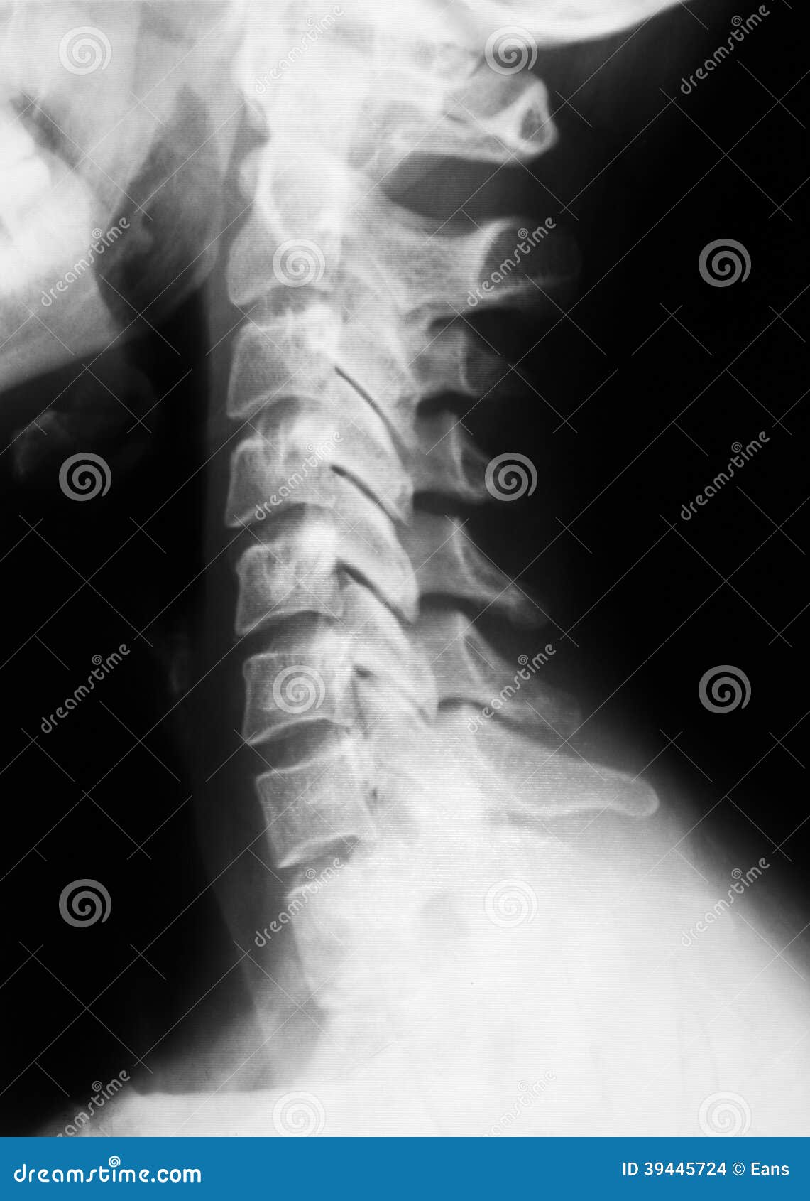 Imagem Do Raio X Da Coluna Espinal Foto de Stock - Imagem de cervical ...