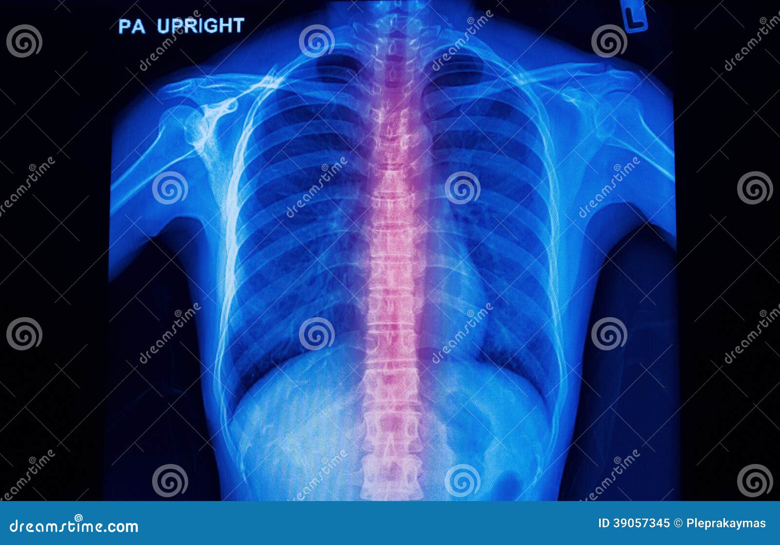 Imagem Do Raio X Da Coluna Espinal Humana Imagem de Stock - Imagem de ...