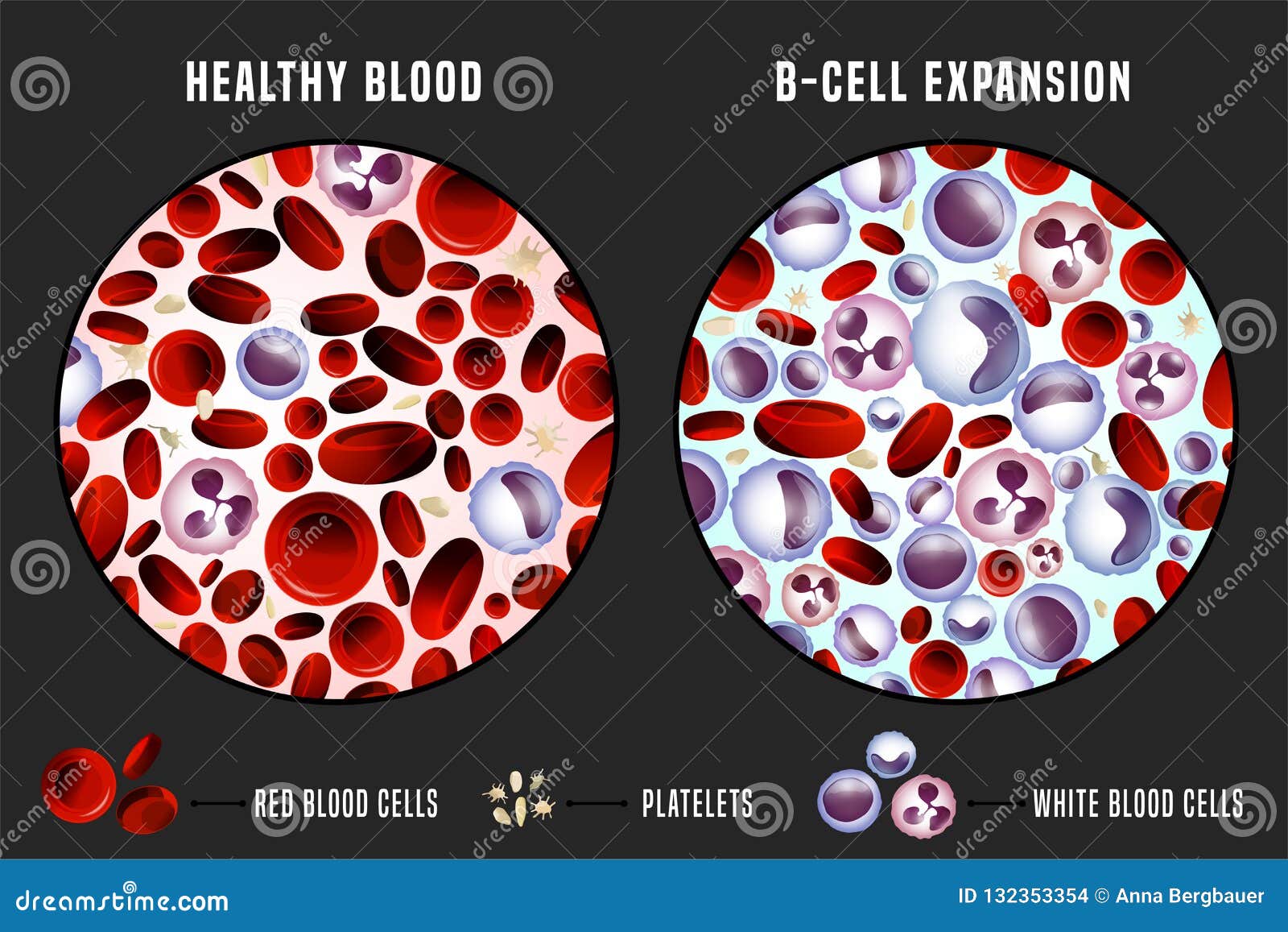 Imagen De Infographic De La Leucemia Ilustración del Vector ...