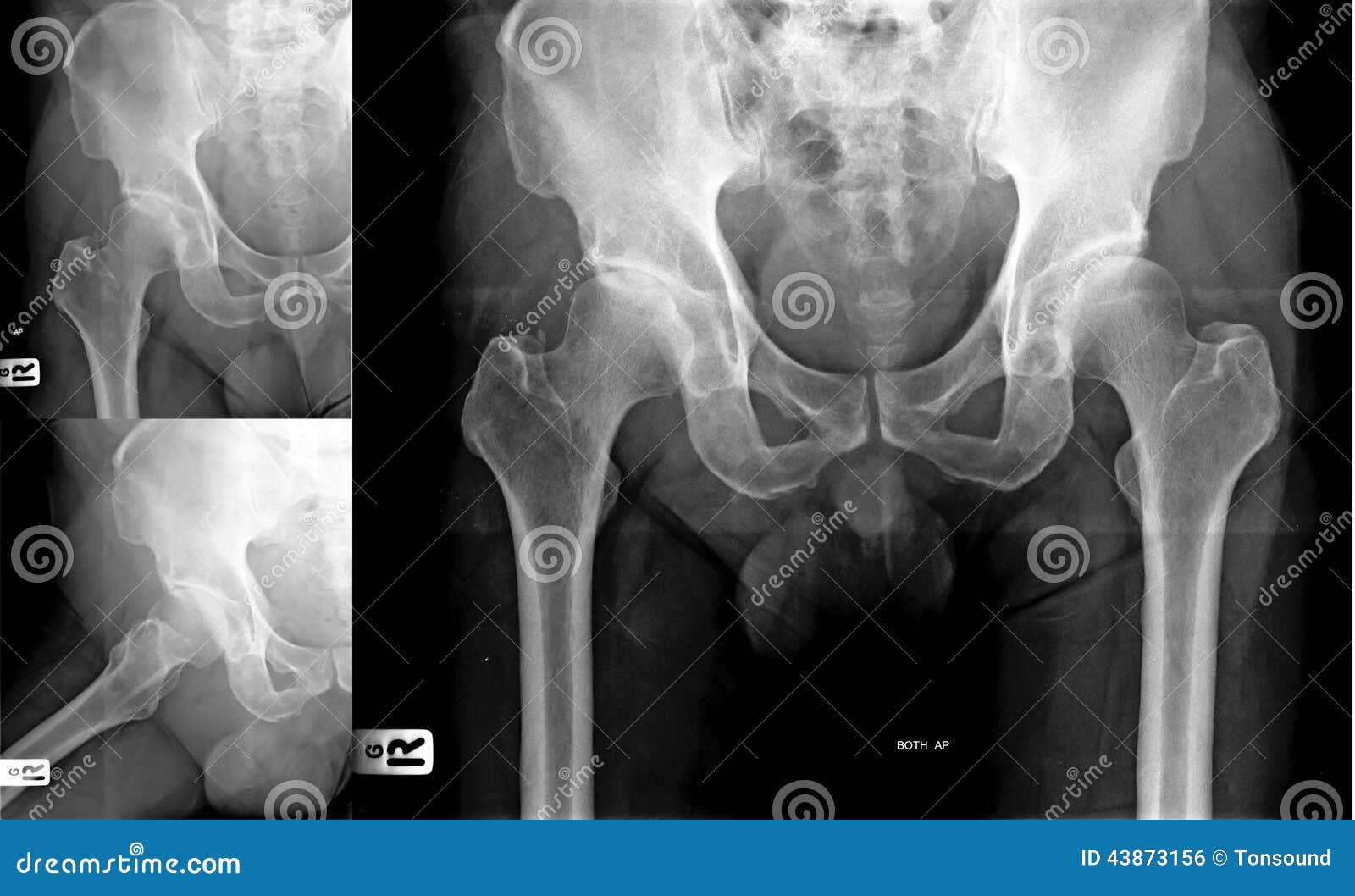 Imagen De La Radiografía De La Cadera Foto de archivo - Imagen de ...