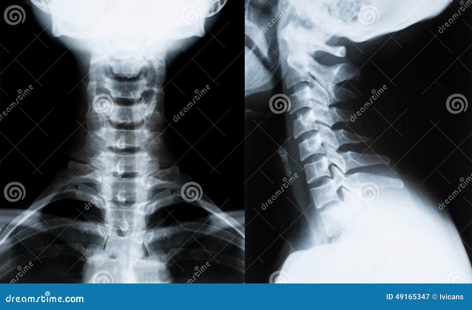 Imagen De La Radiografía Del Cuello Imagen de archivo - Imagen de ...
