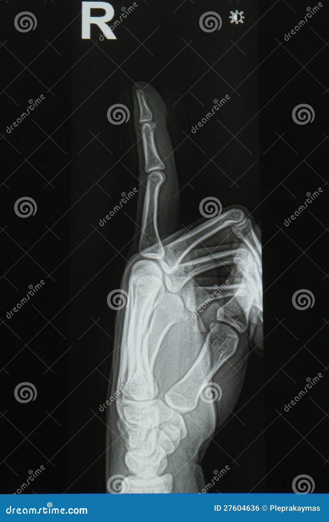 Imagen De La Radiografía Del Dedo Foto de archivo - Imagen de enfermo ...