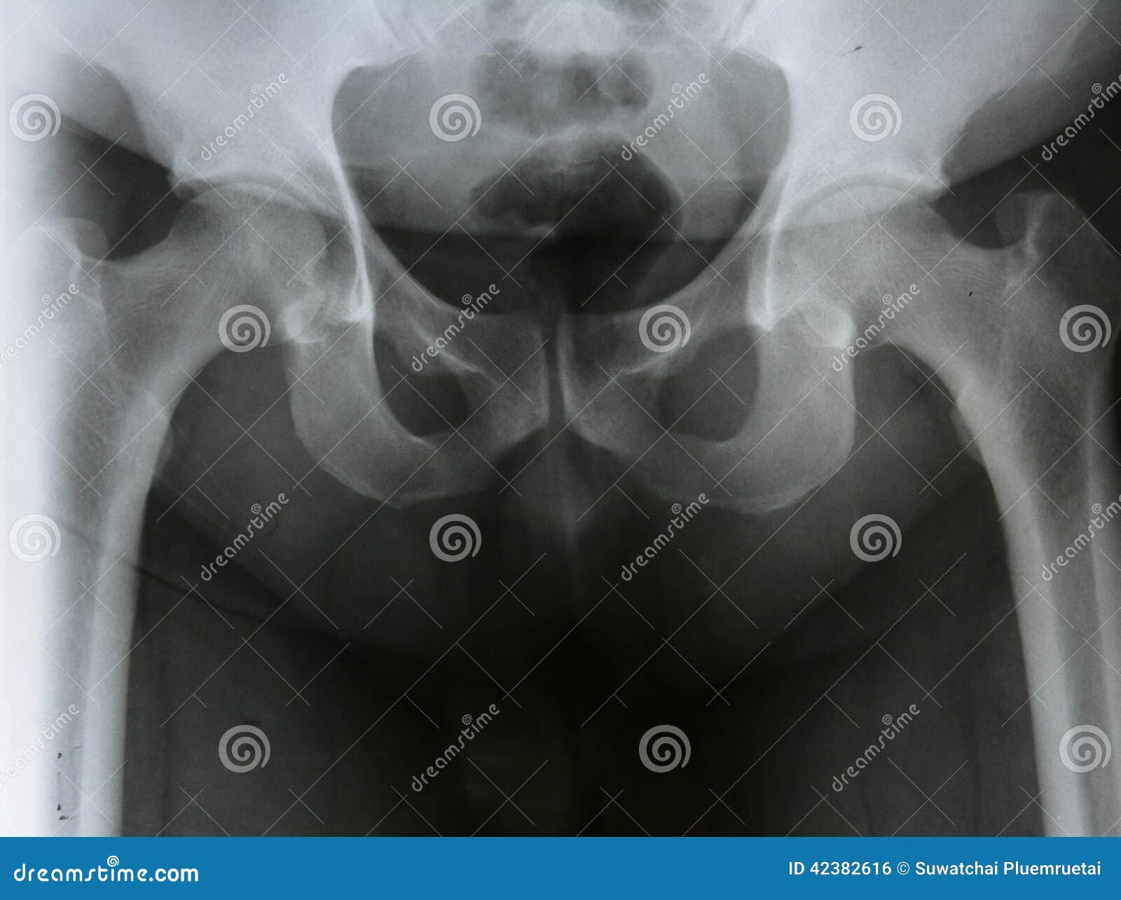 Imagen De Rontgen De La Pelvis Masculina Foto de archivo - Imagen de ...