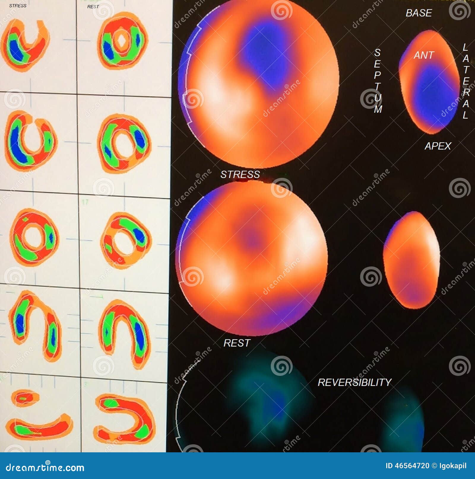 Imagen Del Miocardio Moderada De La Isquemia Foto de archivo - Imagen ...