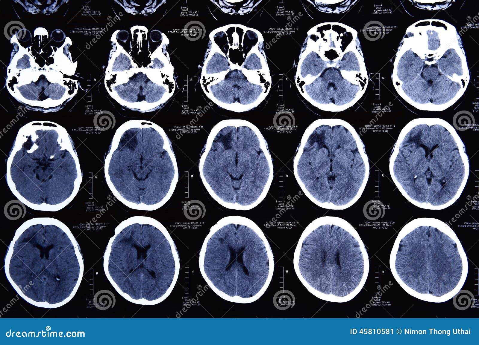 Images from a Computerized Tomography Stock Image - Image of human ...