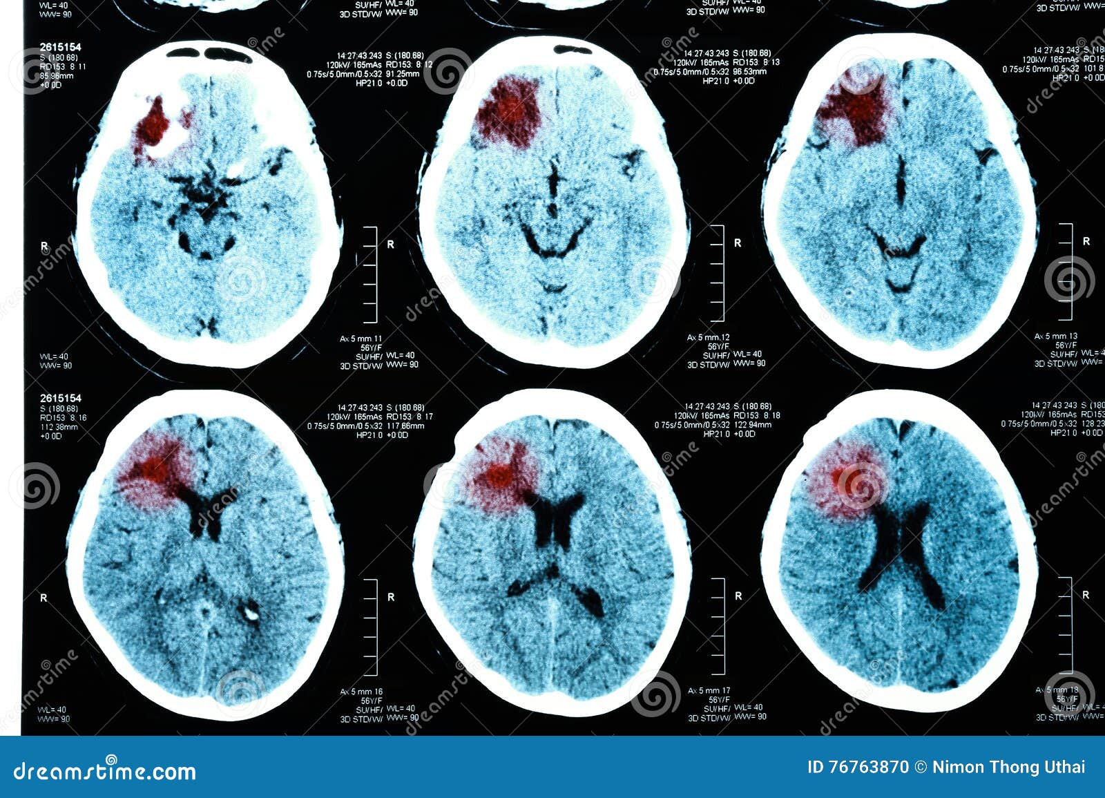 Images from a Computerized Tomography of the Brain Stock Photo - Image ...