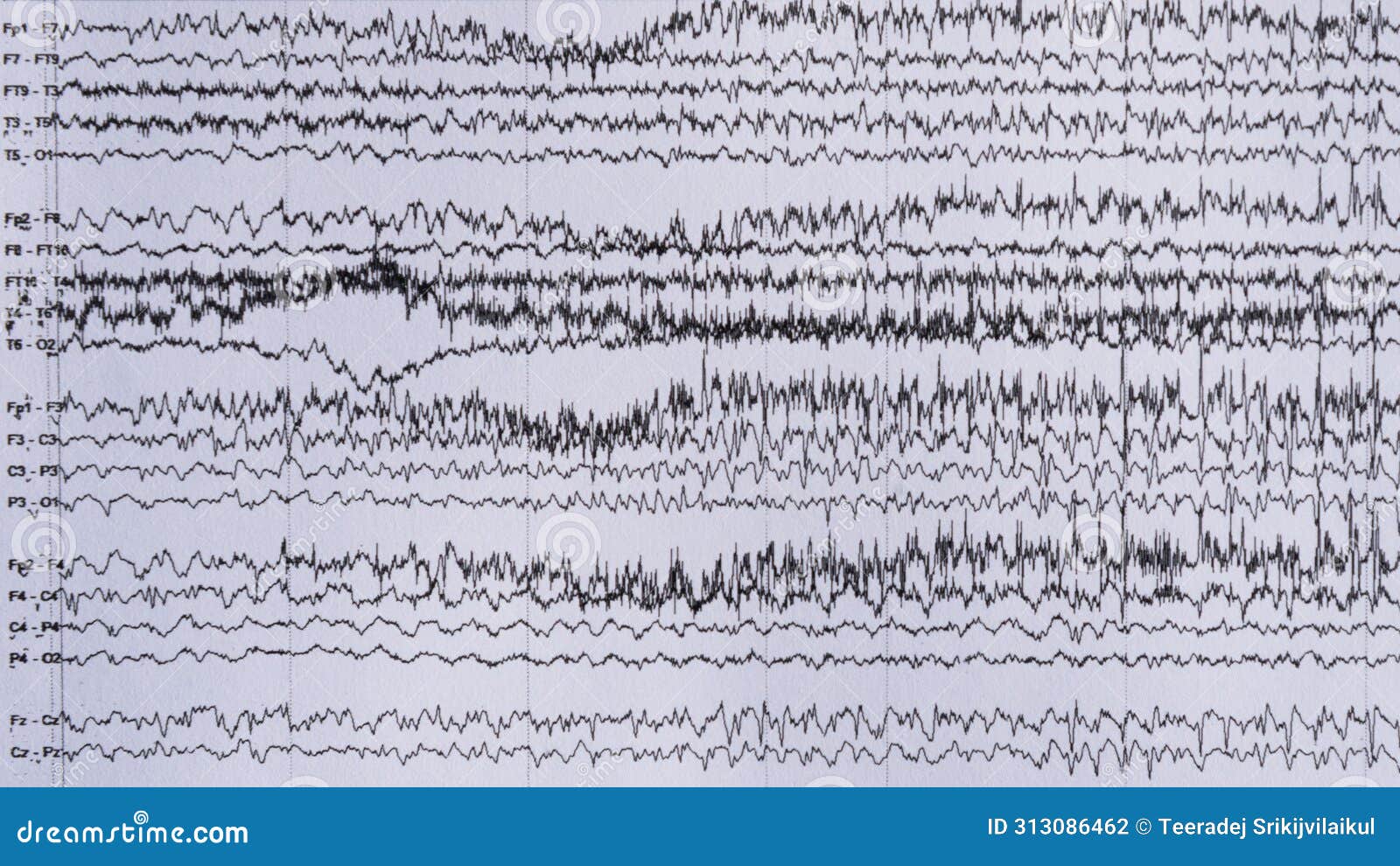 Imaging of Ictal EEG Recording in Epilepsy Patient Stock Photo - Image ... Imaging of Ictal EEG Recording in Epilepsy Patient Stock Photo - Image ...