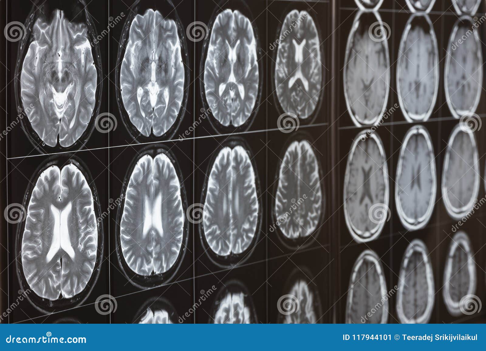 Imagings of Brain MRI on the Light Box Stock Image - Image of sick ...