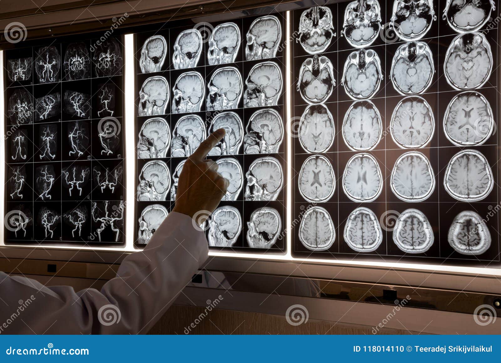 Imagings of Brain MRI on the Light Box Stock Photo - Image of imaging ...