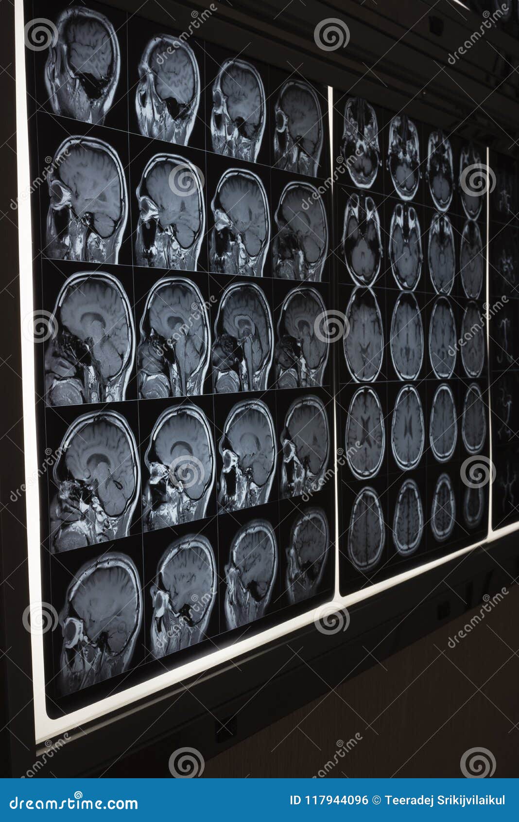 Imagings of MRI of Human Brain Stock Photo - Image of medicine, brain ...