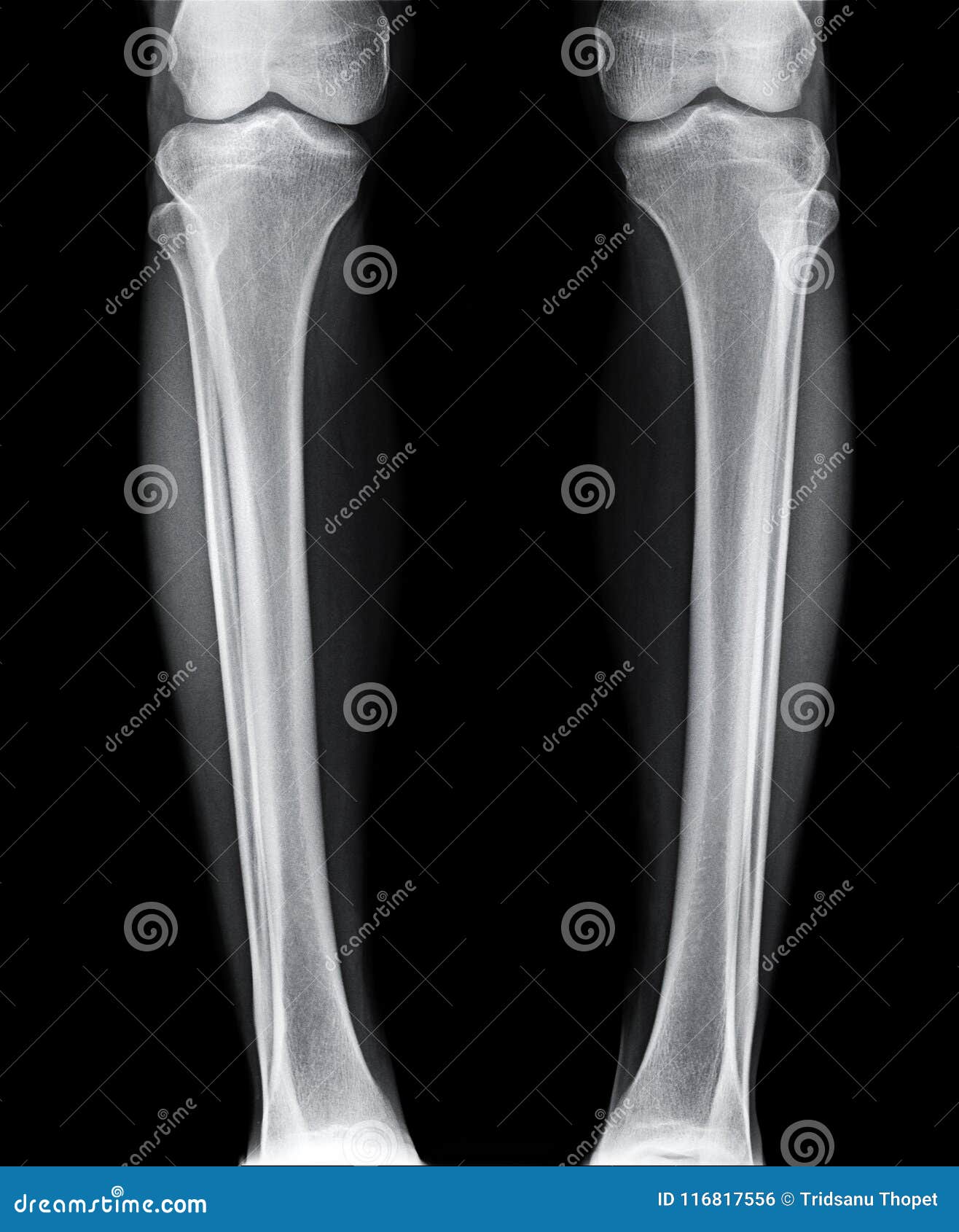 Immagine Dei Raggi X Della Gamba Fotografia Stock - Immagine di umano ...