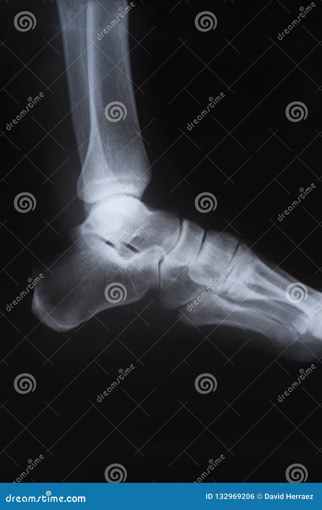 Immagine Medica Del Raggio Di X Del Piede Fotografia Stock - Immagine ...