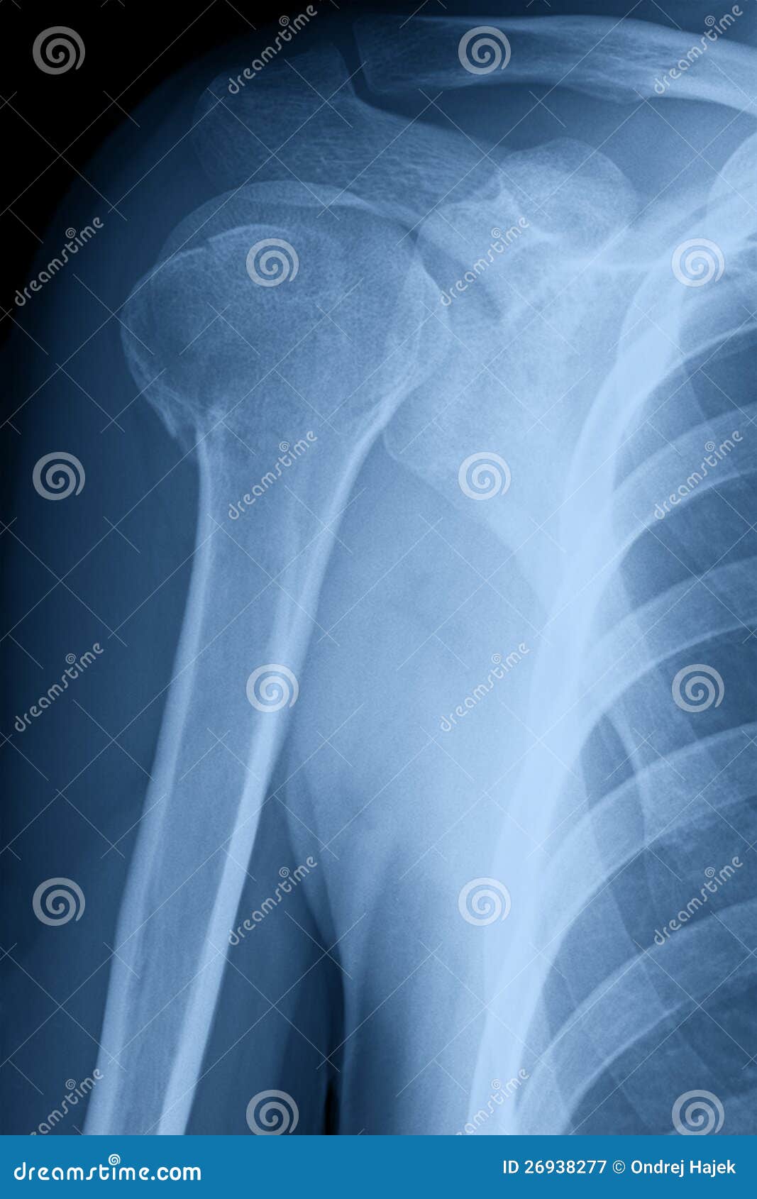 Immagine Rotta Dei Raggi X Della Spalla Immagine Stock - Immagine di ...