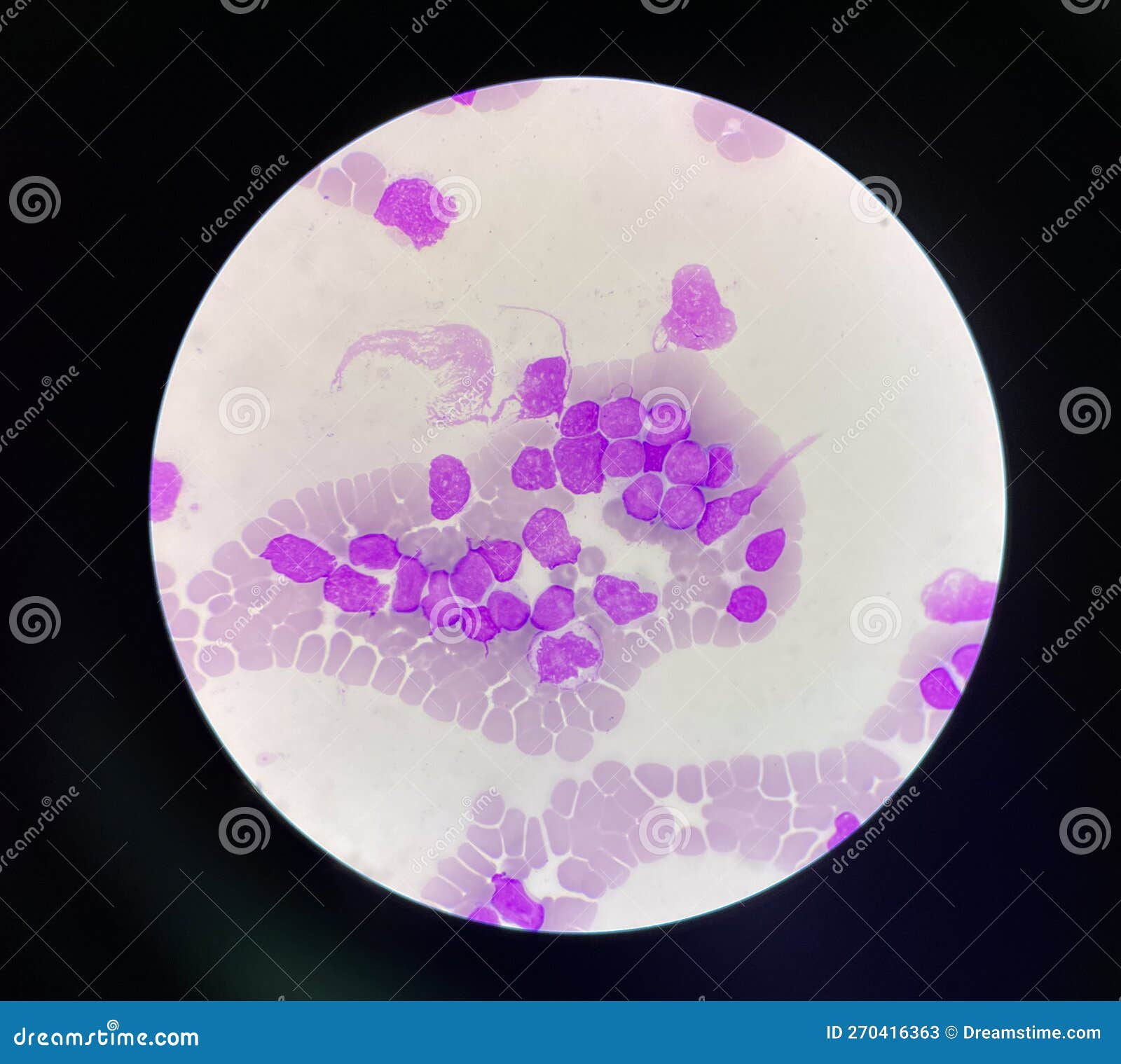 Immatture Wbc Acute Lyphoblastic Leukemia Stock Image - Image of marrow ...