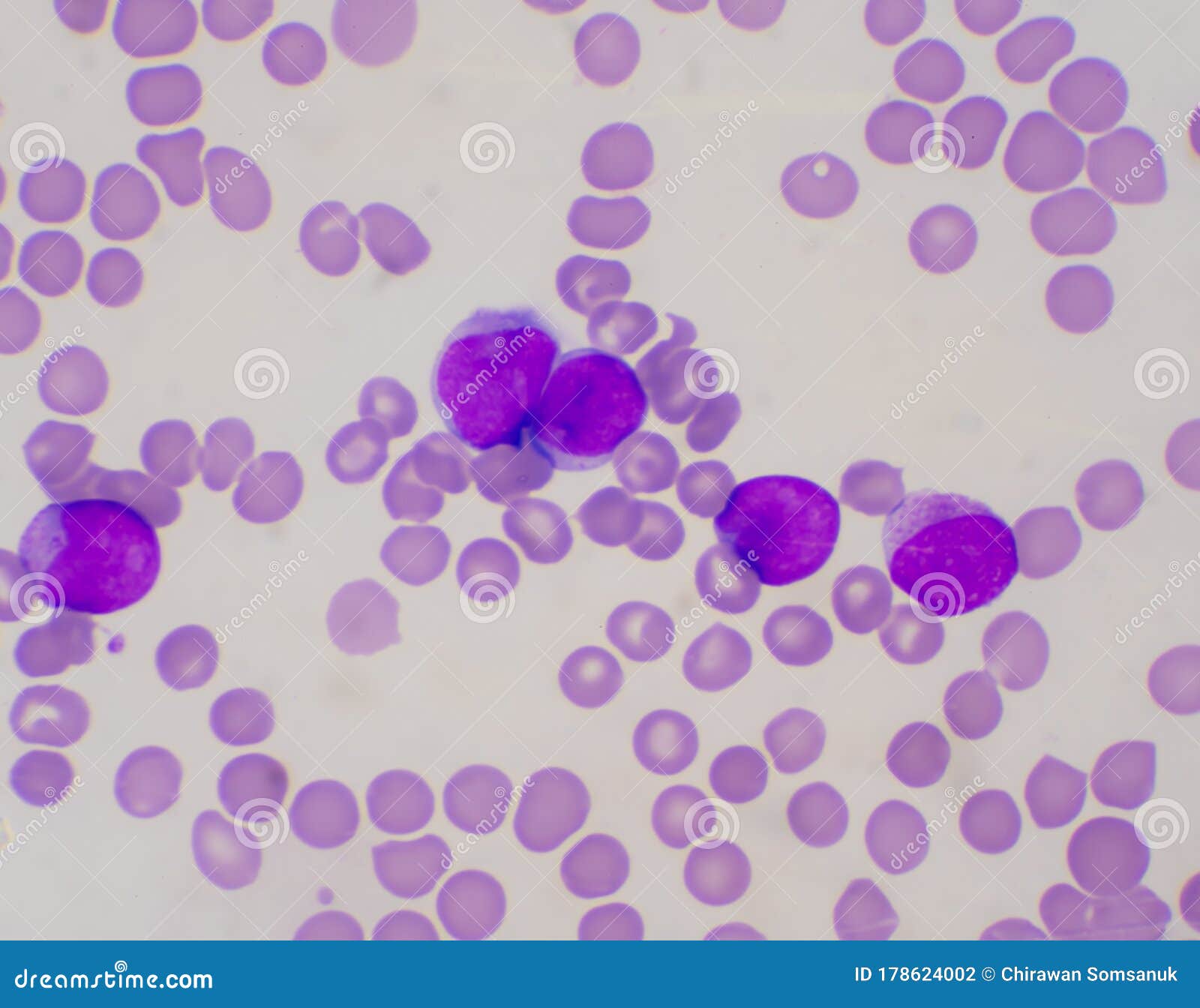 Immature White Blood Cells In Blood Smear Stock Photo | CartoonDealer ...