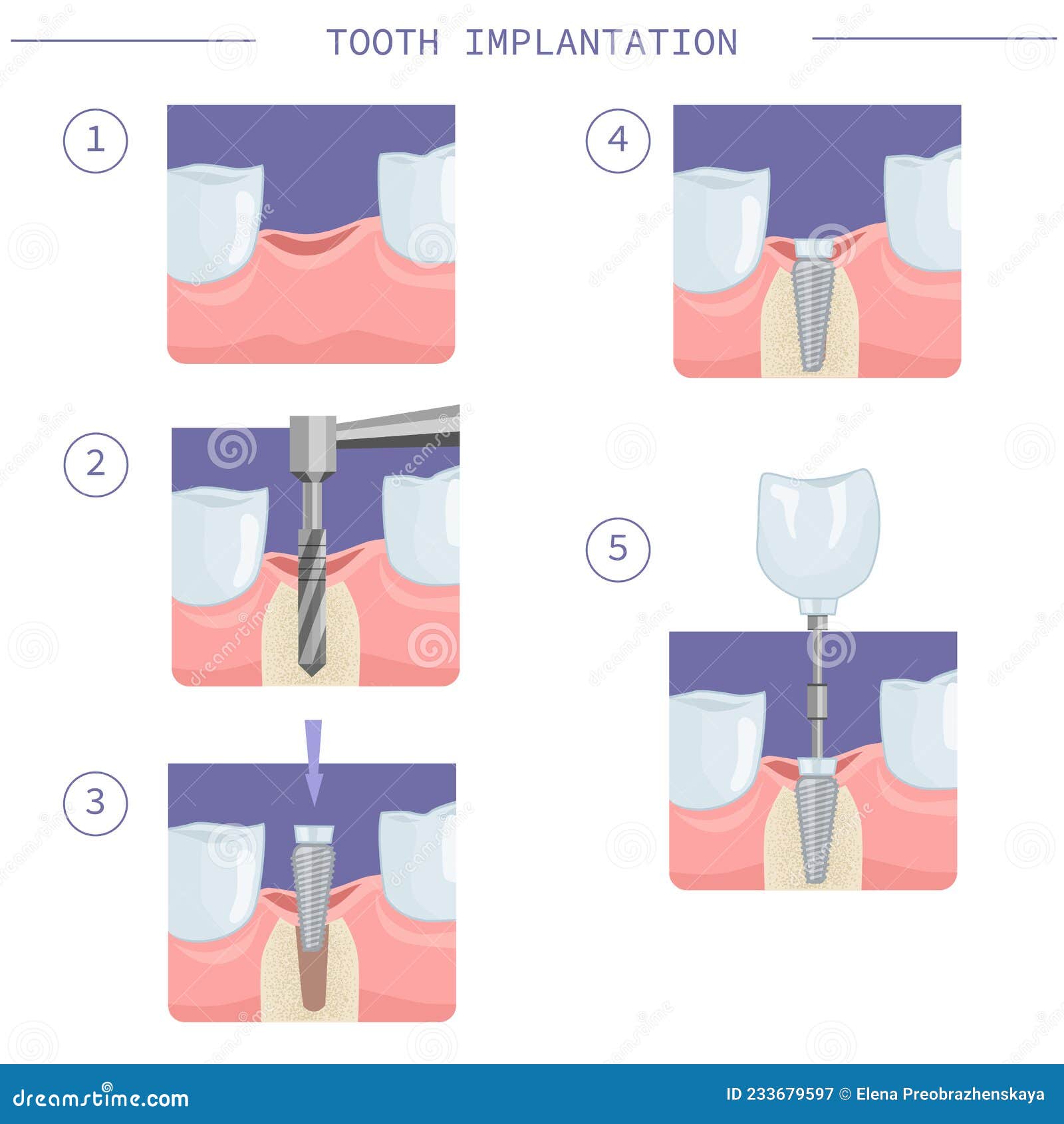 Immediate Dental Implantation. Modern Dental Implantation, Step by Step ...