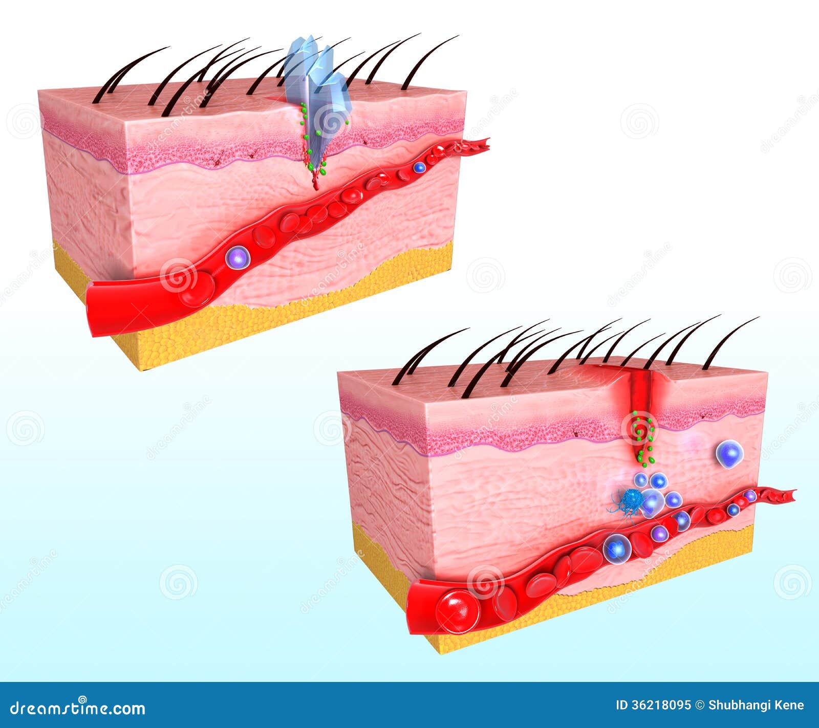 Immune Response System of Human Skin Stock Illustration - Illustration ...