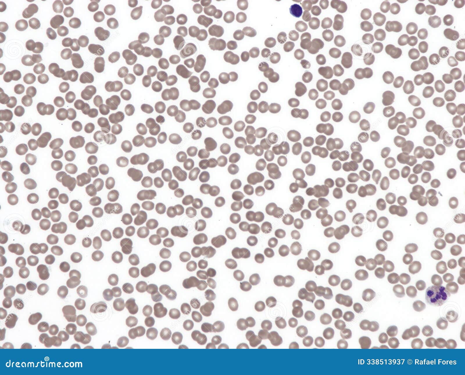 Immune Thrombocytopenic Purpura. Peripheral Blood. Stock Image - Image ...