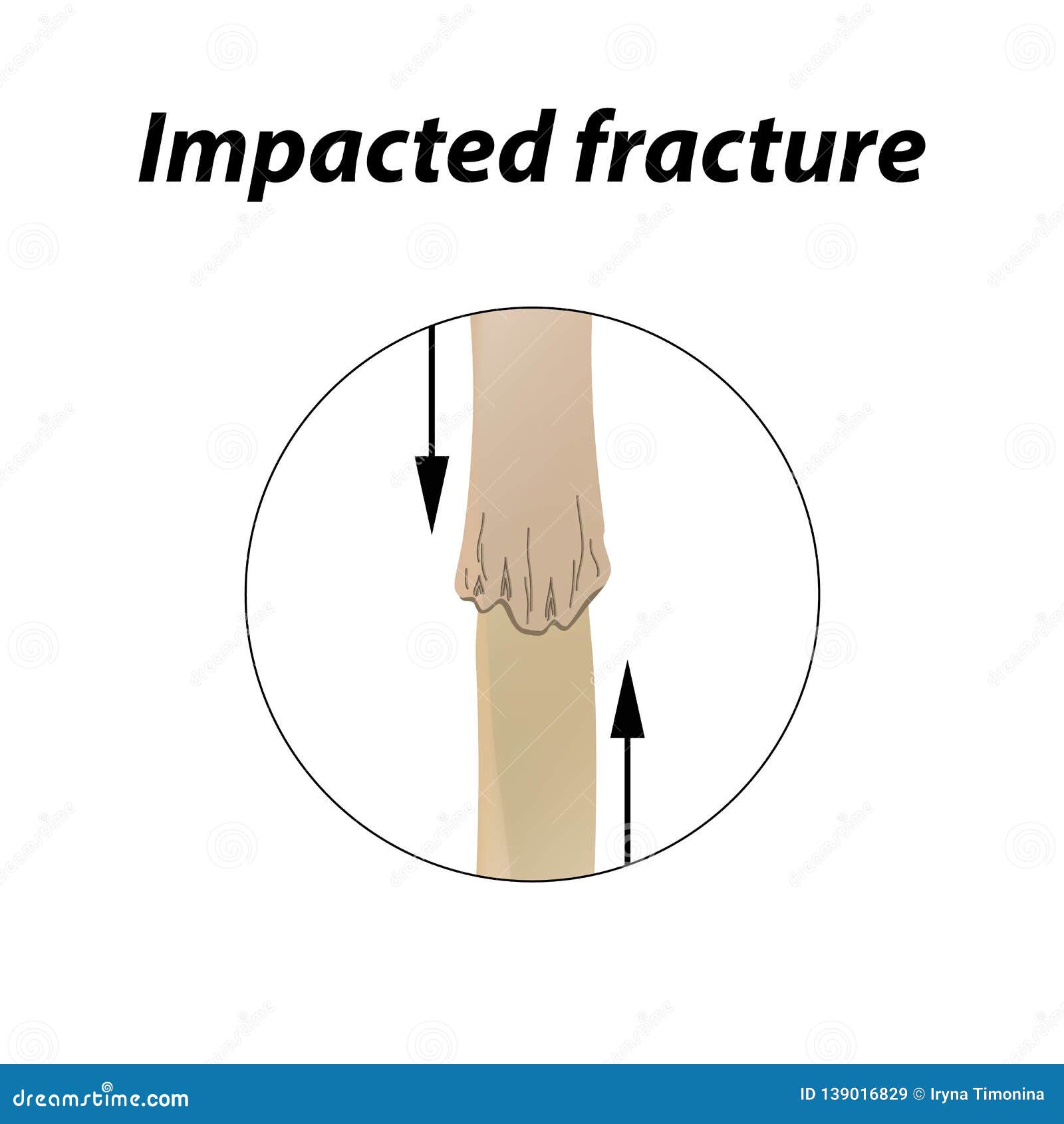 Impacted Fracture Bone. Infographics. Vector Illustration on a Lined ...