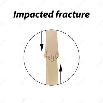 Impacted Fracture Bone. Infographics. Vector Illustration on a Lined ...
