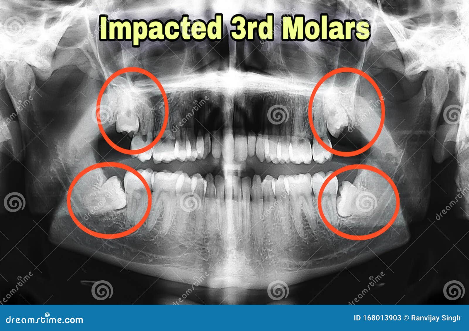 Impacted Teeth stock image. Image of dental, impaction - 168013903