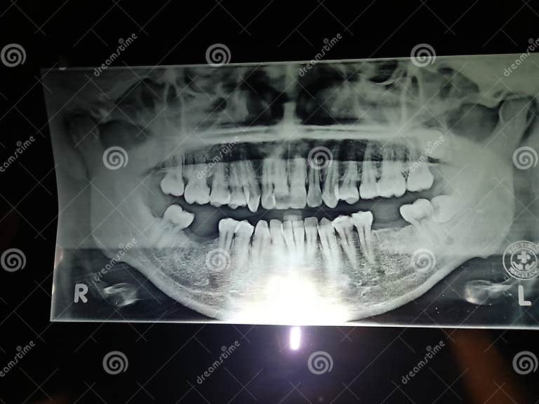 Impacted Teeth Panoramic X-ray Editorial Stock Photo - Image of white ...