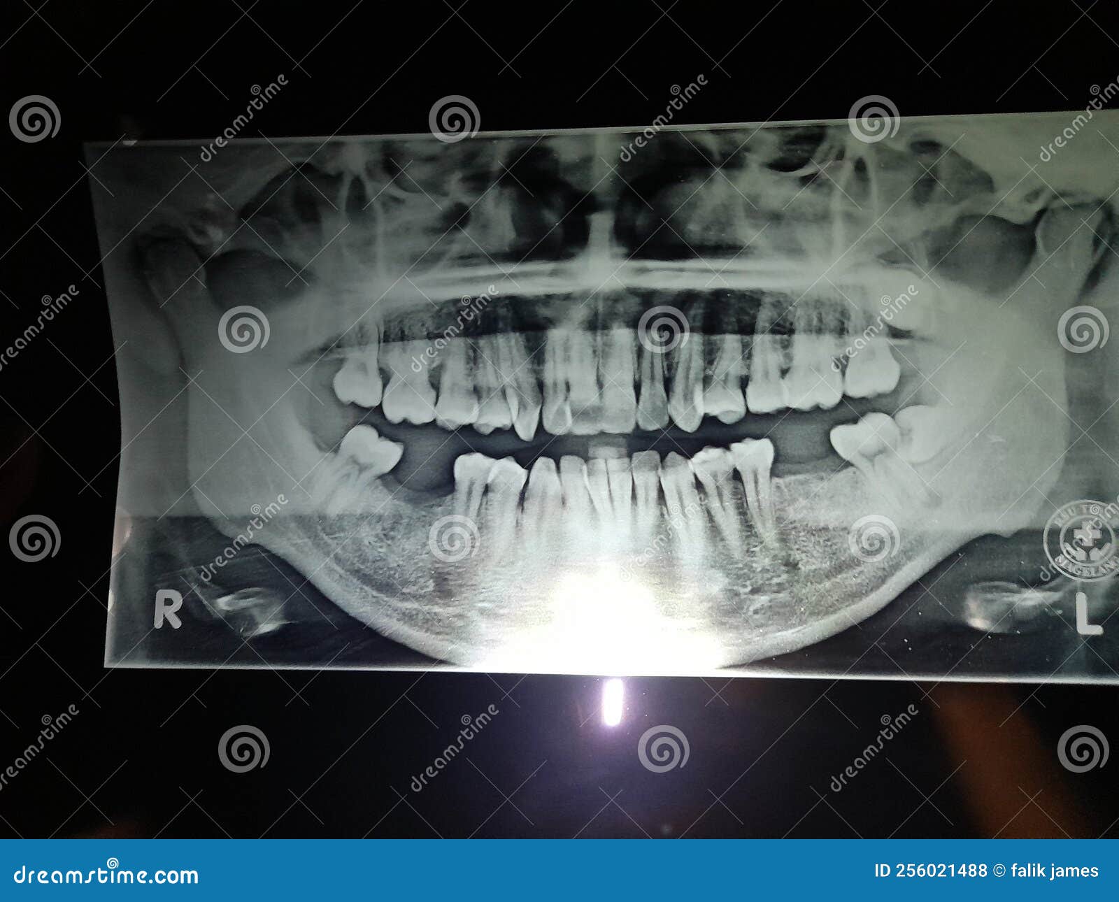 Teeth - Impacted Tooth Cross-section Diagram Stock Image ...