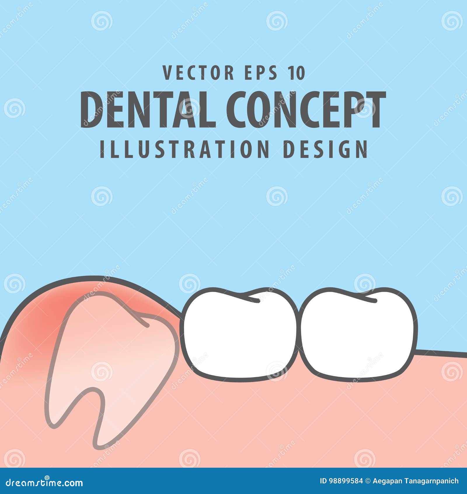Impacted Tooth Inside Under Inflammation Gum Illustration Vector Stock ...