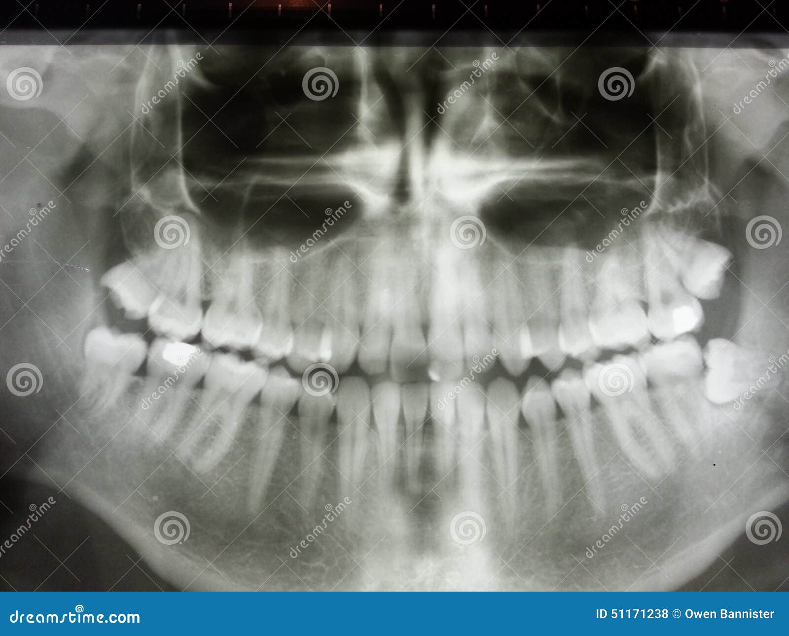 Teeth - Impacted Tooth Cross-section Diagram Stock Image ...