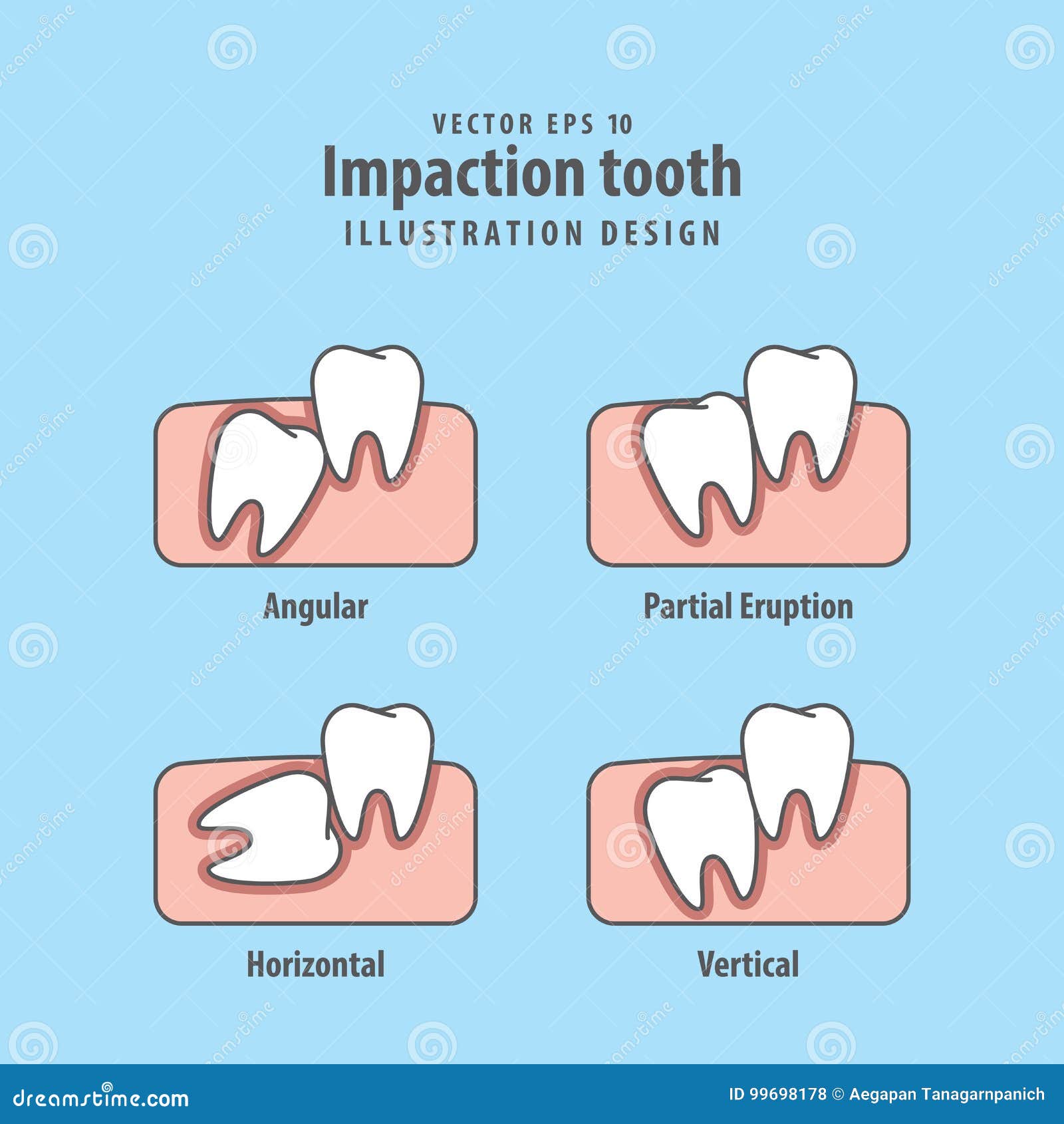 Impaction Tooth. Dentistry Stomatology Vector | CartoonDealer.com ...