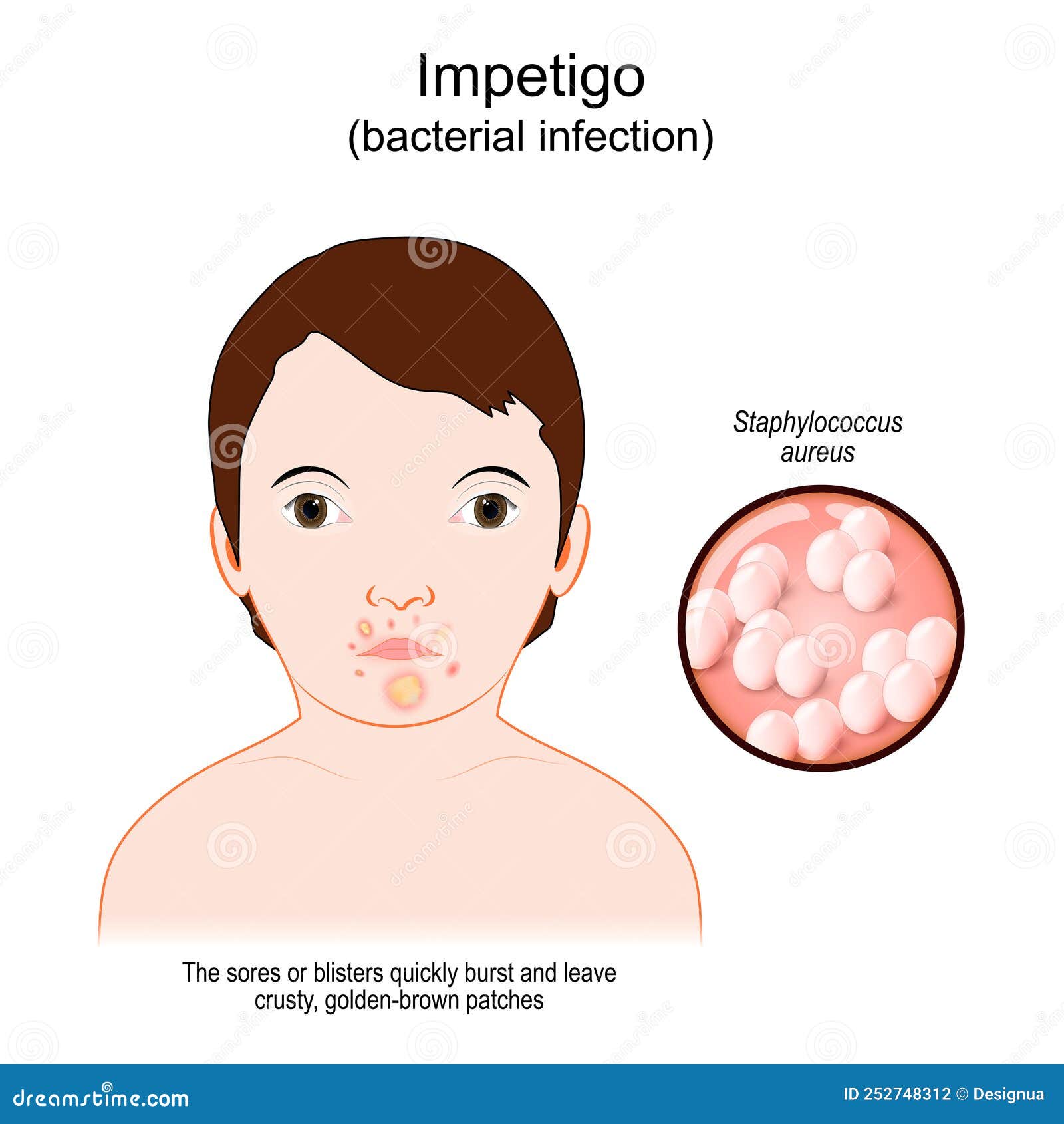 Impetigo Is An Infection Caused By Strains Of Staphylococcus Or ... Impetigo Is An Infection Caused By Strains Of Staphylococcus Or ...