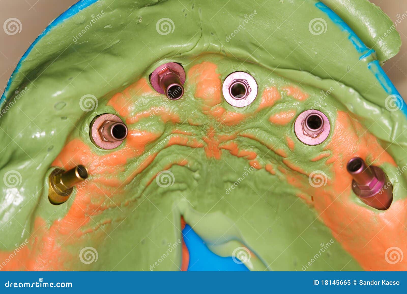 Implant - impression stock image. Image of prosthetics - 18145665