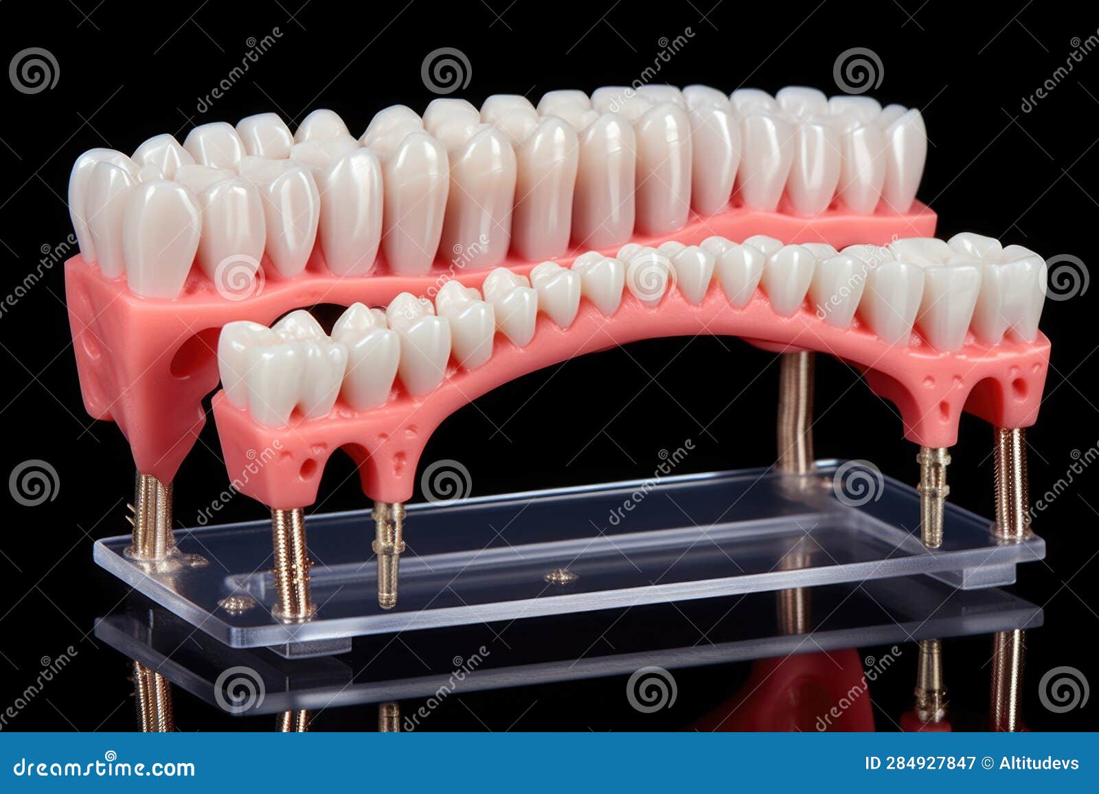 Implant-supported Dental Bridge Model Stock Image - Image of dental ...