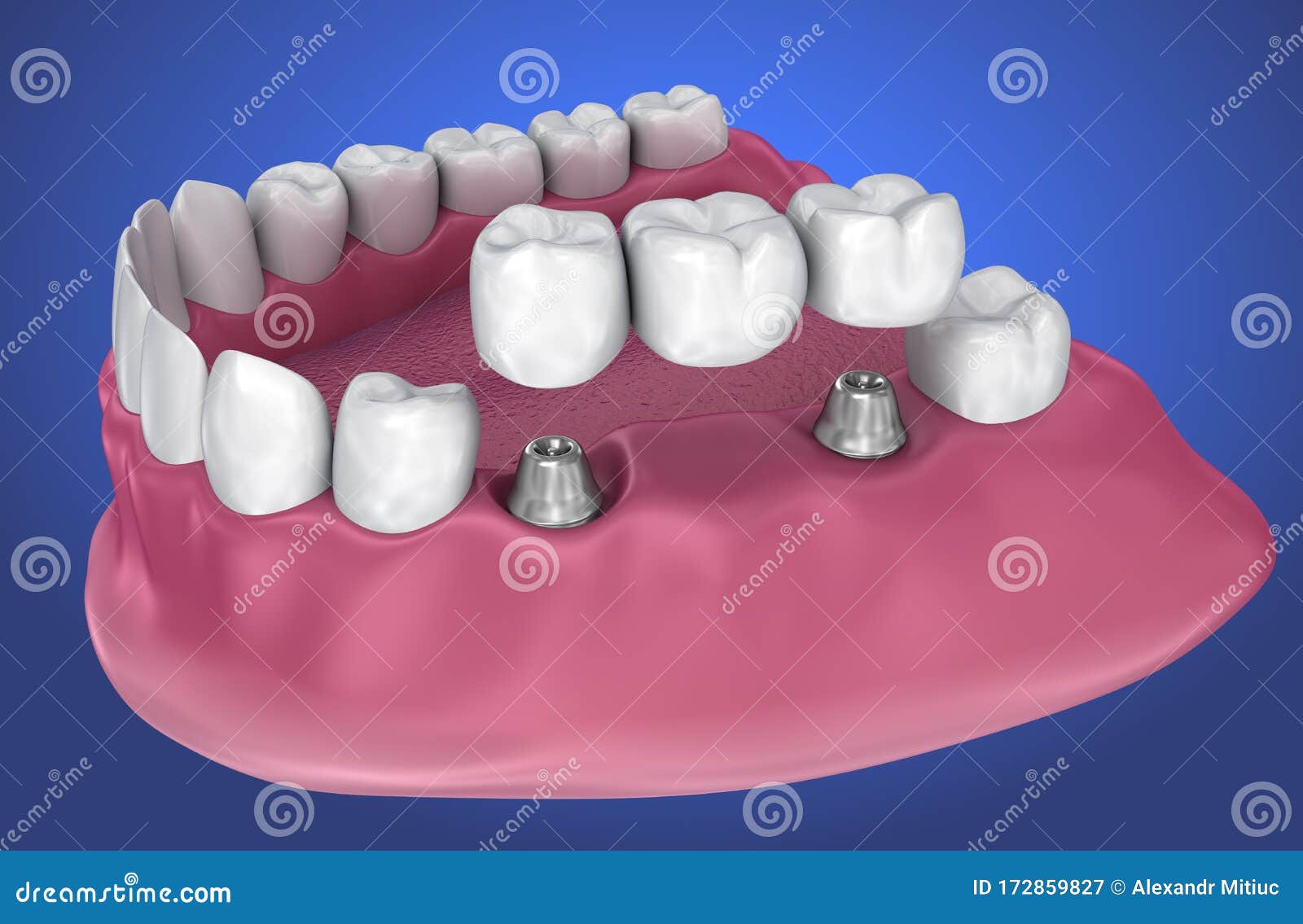 Implant Supported Fixed Bridge. Medically Accurate Stock Illustration ...