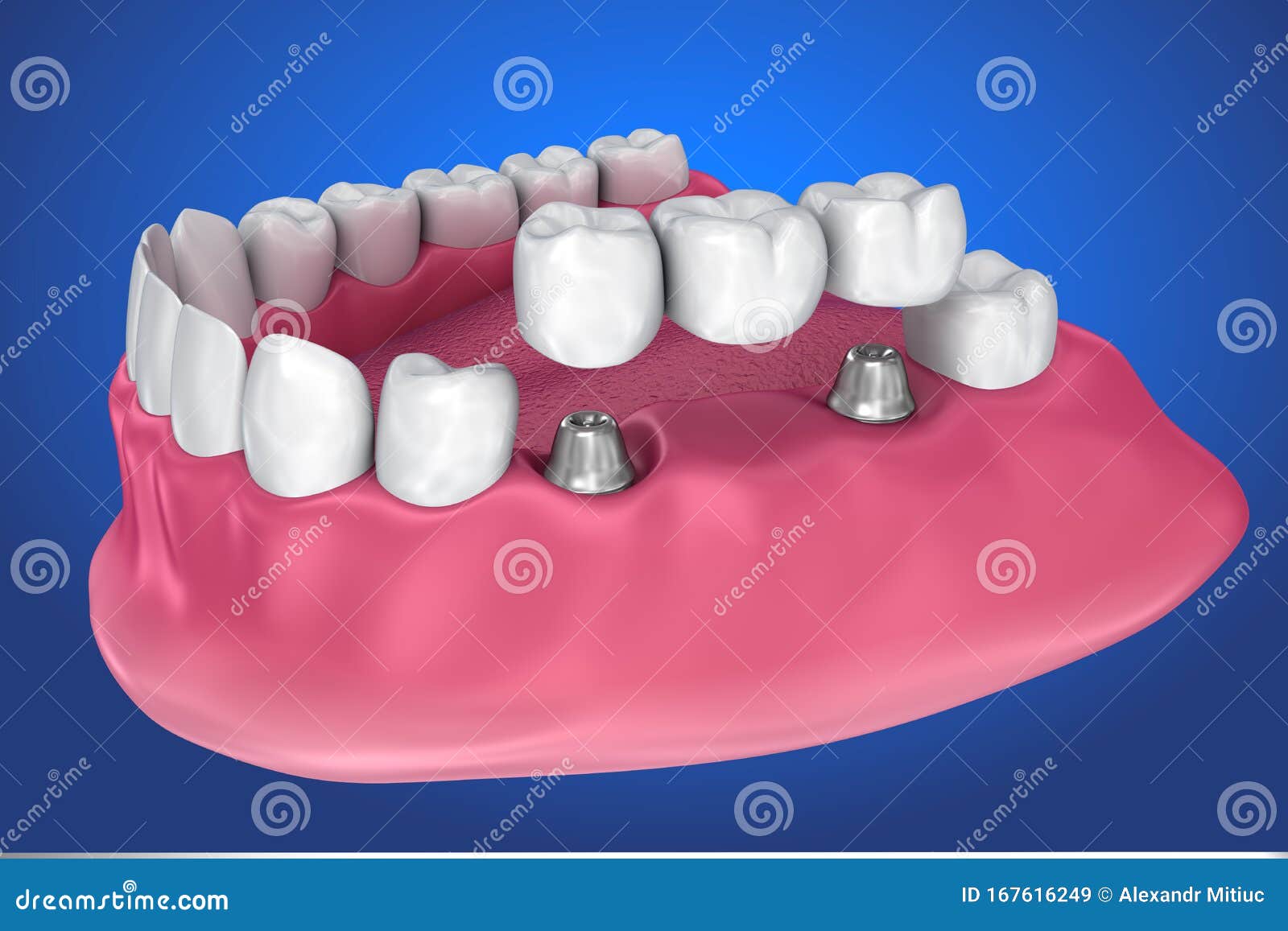 Implant Supported Fixed Bridge. Medically Accurate Stock Illustration ...