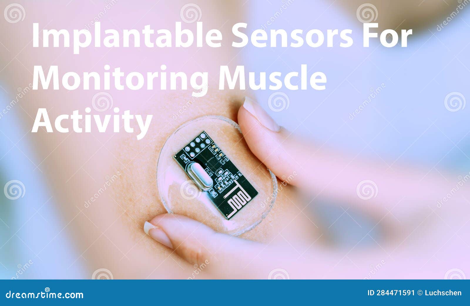 Implantable Sensors for Monitoring Muscle Activity Implantable Electro ... Implantable Sensors for Monitoring Muscle Activity Implantable Electro ...