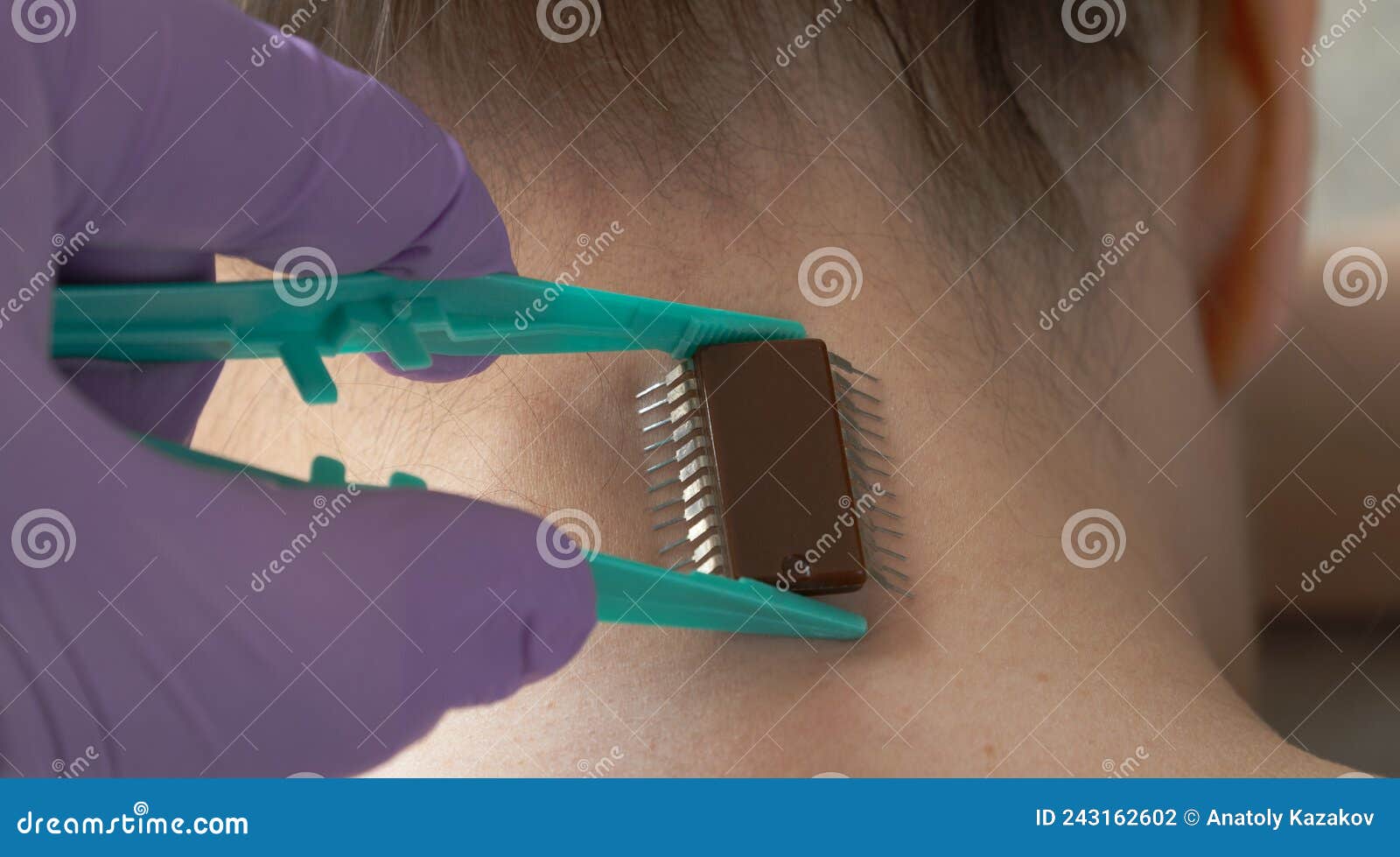 Implantation of a Microchip Under Human Skin. Human Mind Control Using ...
