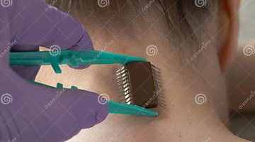 Implantation of a Microchip Under Human Skin. Human Mind Control Using ...