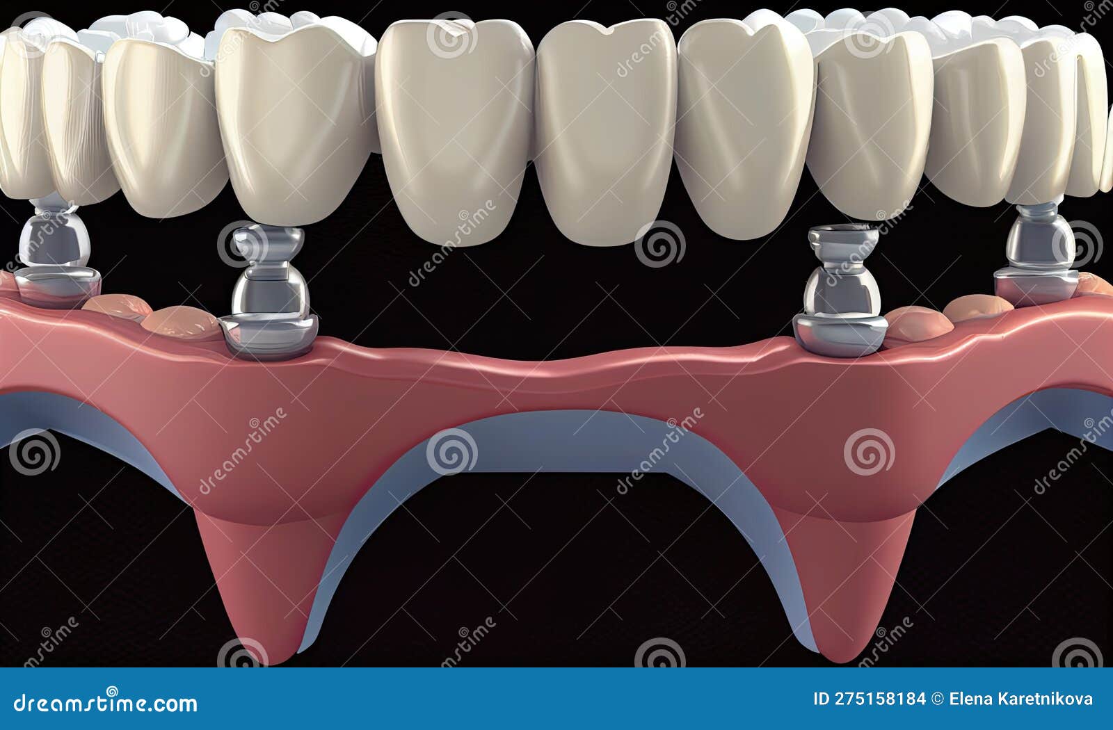 The Implantation Process in Dentistry, Generative AI Stock Illustration ...