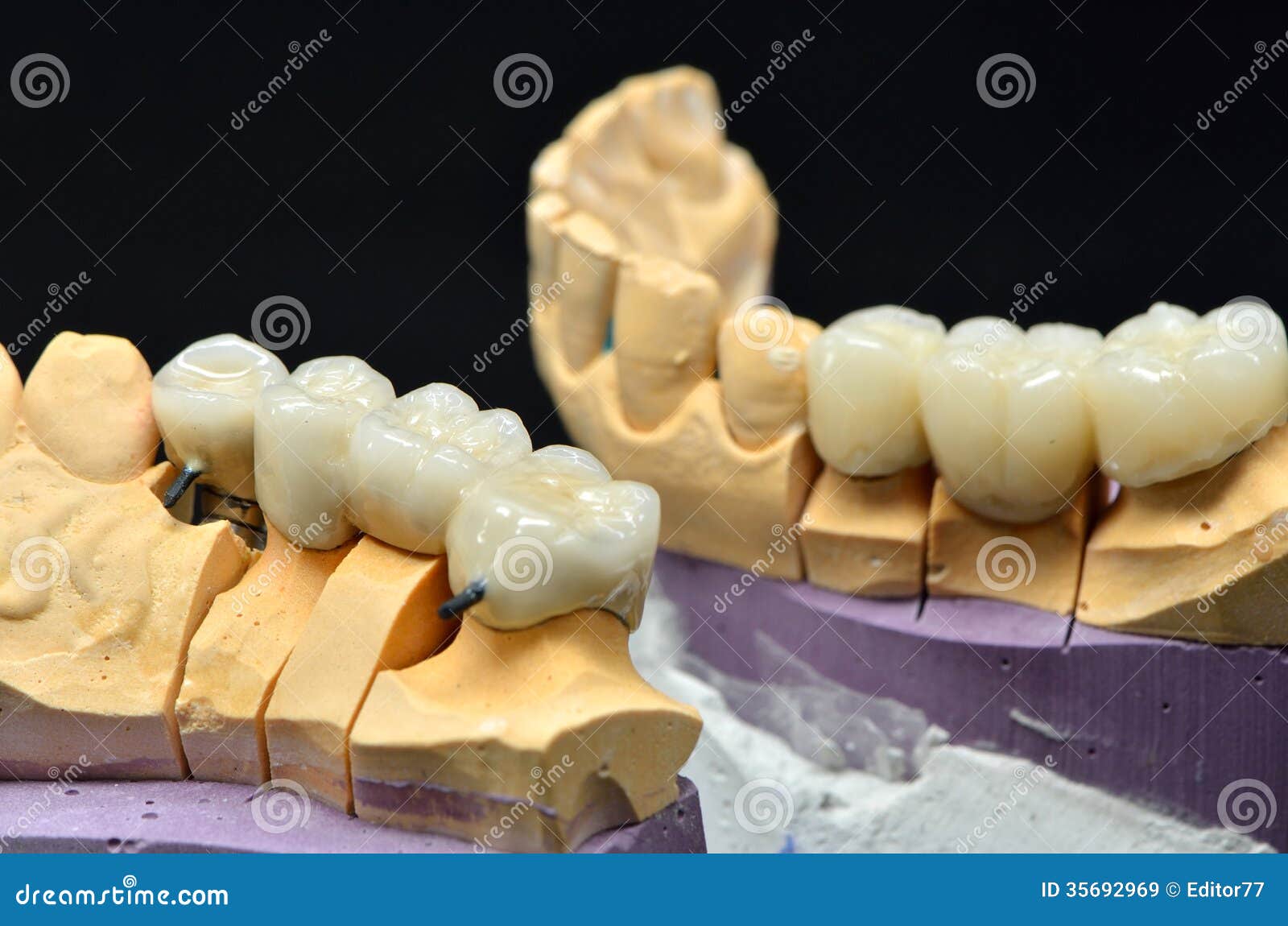 Teeth Models with Bridge Implants Stock Image - Image of prosthesis ...