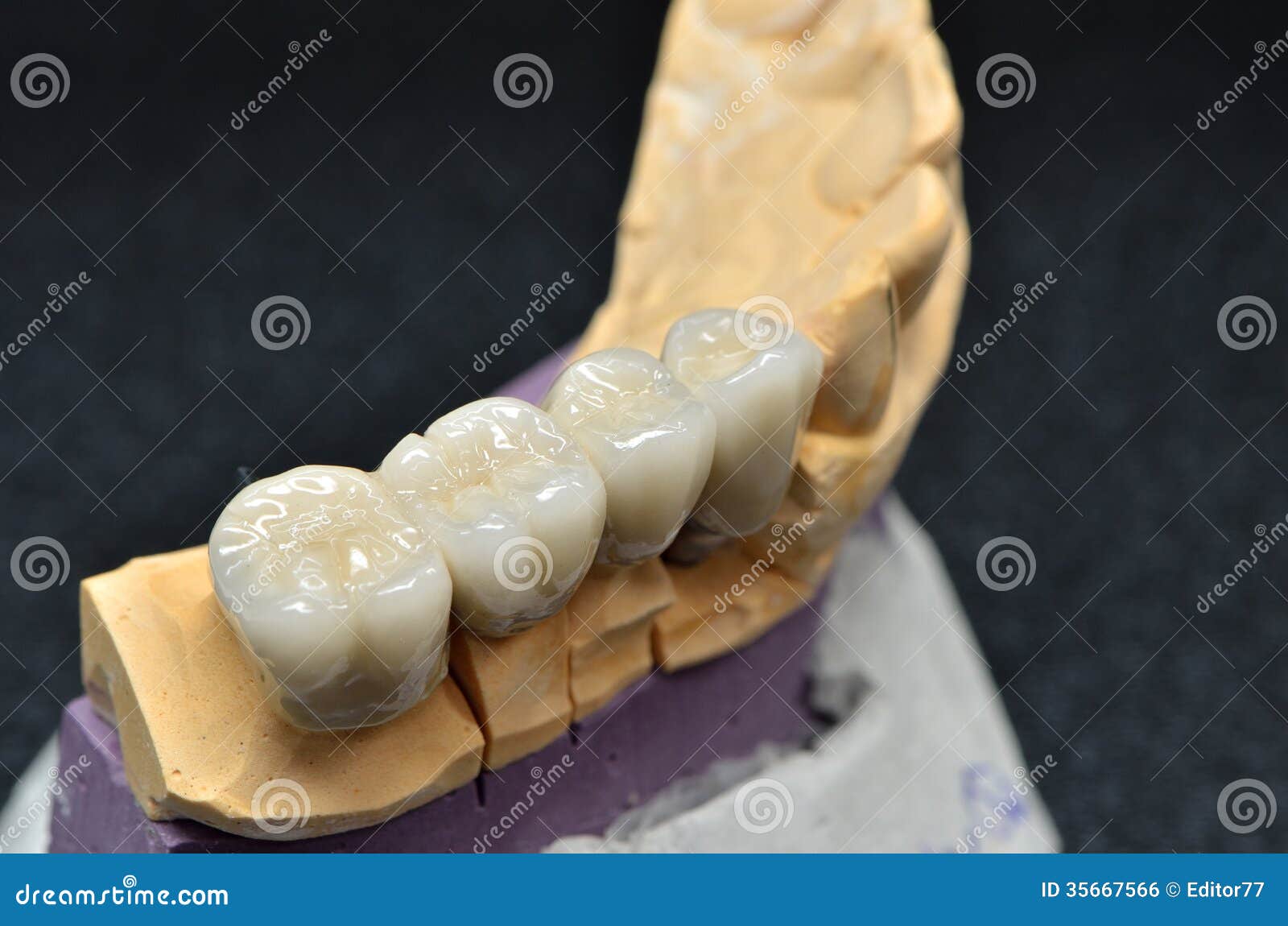 Teeth and porcelain crown stock photo. Image of yellow - 35667566