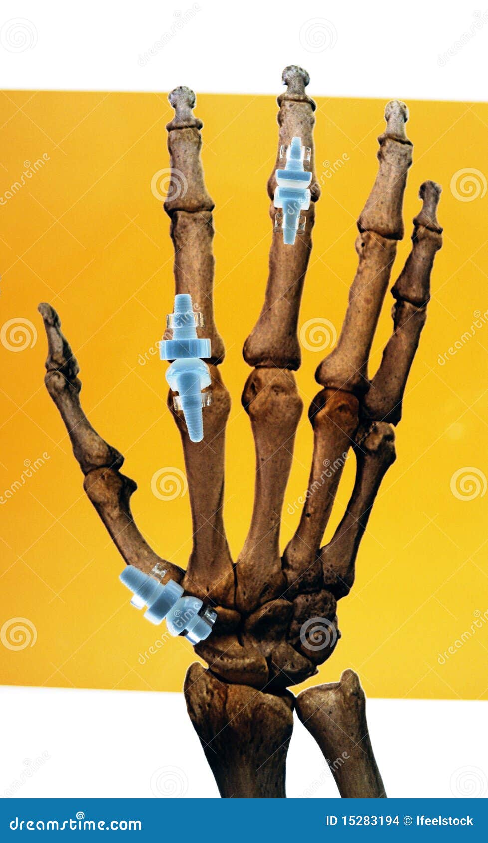 Implants in human hand stock photo. Image of fibula, background - 15283194