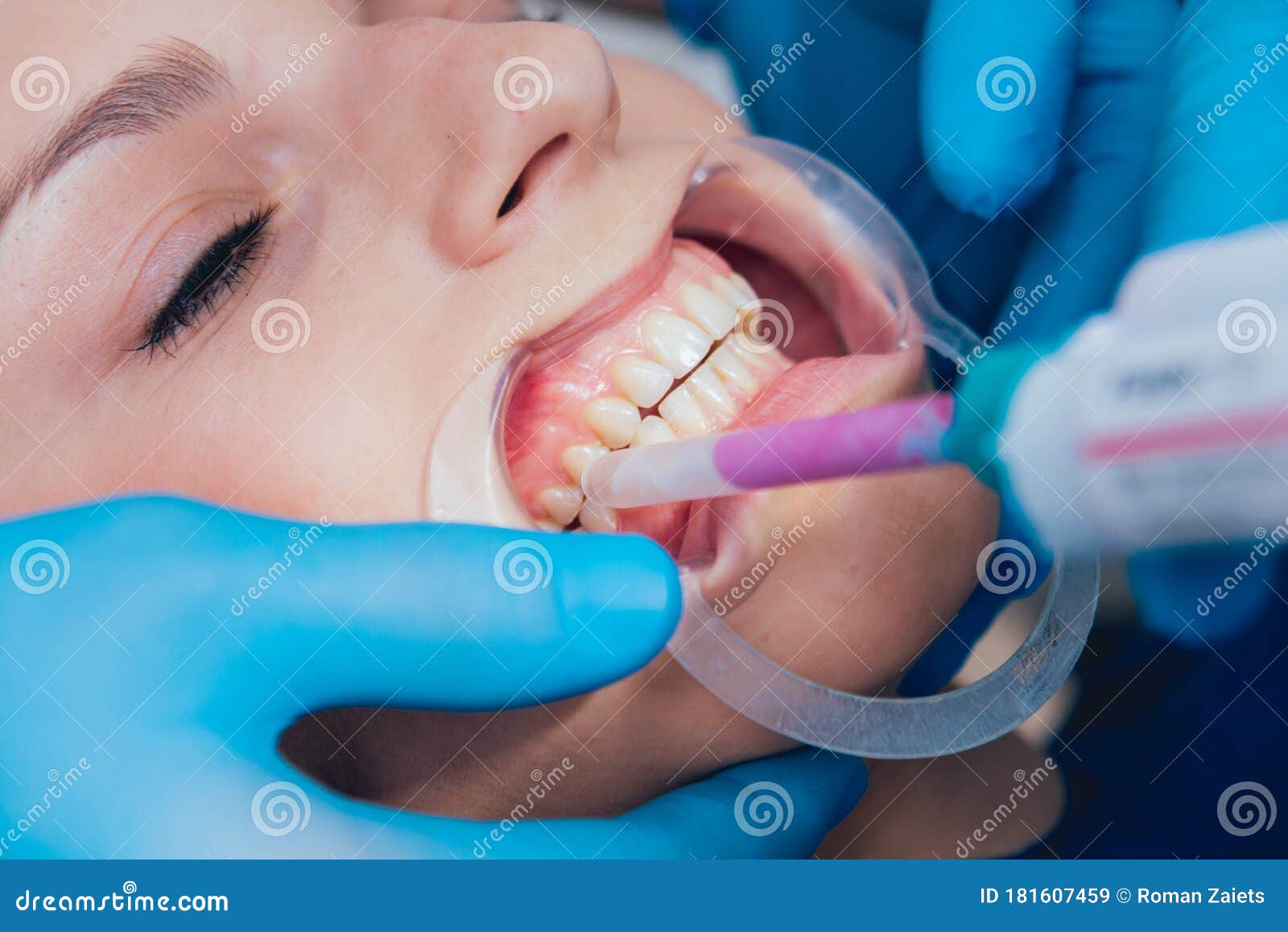 Impression Taking and Bite Registration. Functional Diagnostics Stock ...