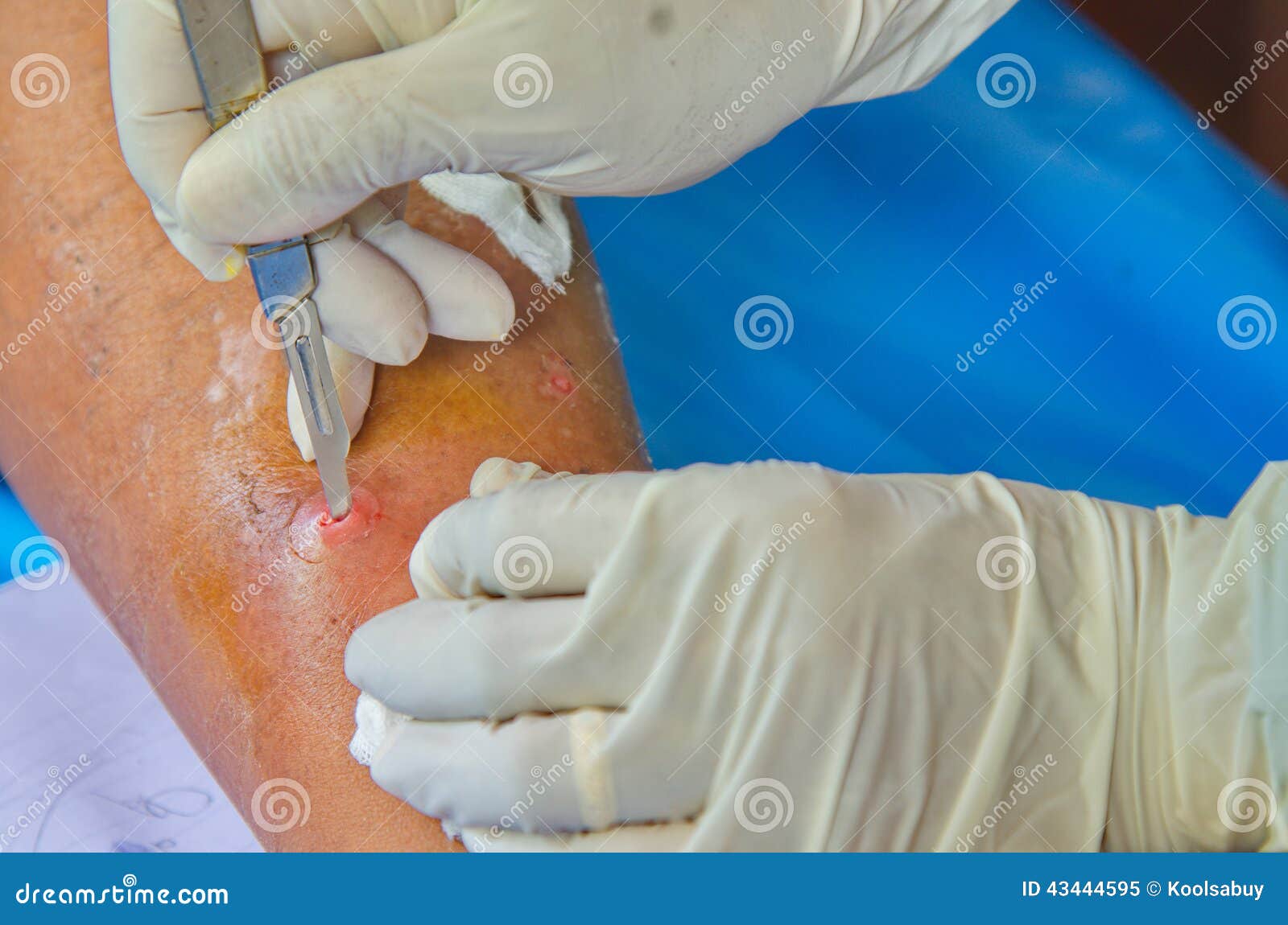Incision. Royalty-Free Stock Photography | CartoonDealer.com #43444595
